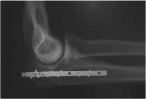 Lateral Radiograph After Osteosynthesis Shows The Intramedullary