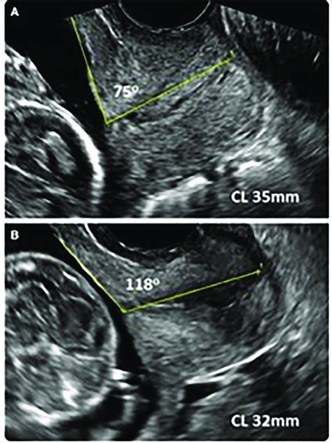 The Measurement Of Uca From 25 Download Scientific Diagram