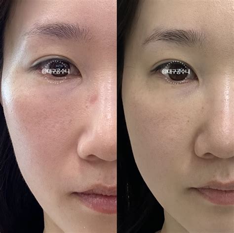 30년 앓던 얼굴홍조 원인과 안면홍조 없애는법 치료 과정 공개 네이버 블로그