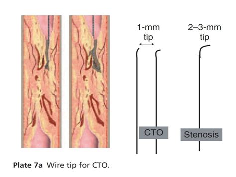 Choice And Use Of Appropriate Guidewire In Pci