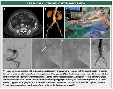 Advancing The Standard Of Care In Peripheral Embolization