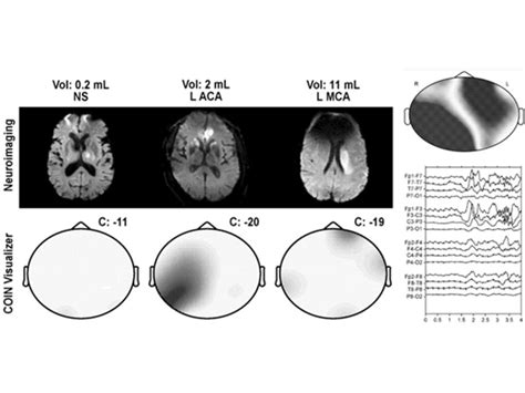 Point Of Care Brain Monitoring Algorithm For Detecting Stroke In Point Of Care Brain Monitoring Algorithm For Detecting Stroke In