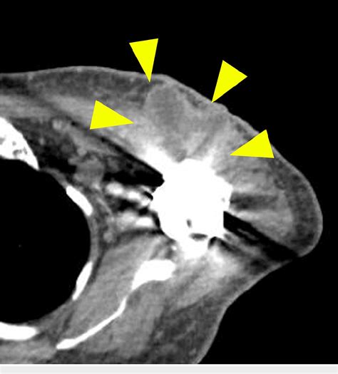 Figure 2 From Periprosthetic Joint Infection Following Reverse Shoulder