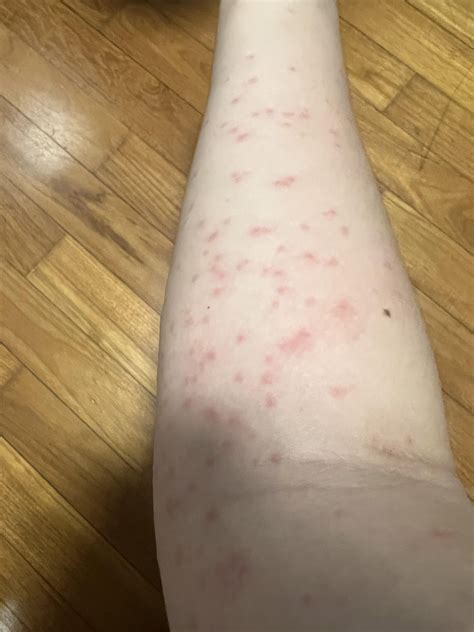Is This Hiv Rash Had Unprotected Sex 2 Days Ago Very Worried As It