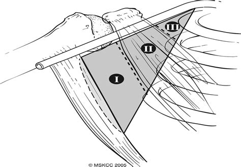 Sentinel Lymph Node Biopsy And Axillary Dissection Added Mo The Cancer Journal