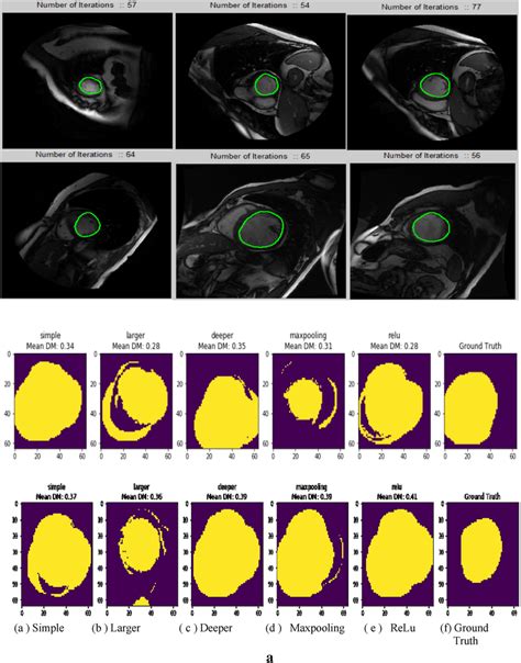 Adaptive Iteration Based Deformable Model Tested On Typical Cardiac Mr Download Scientific