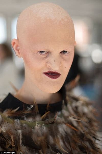 Ectodermal Dysplasia Genetic Disorder Left Model With No Tooth Pores Etc Pics Celebrities