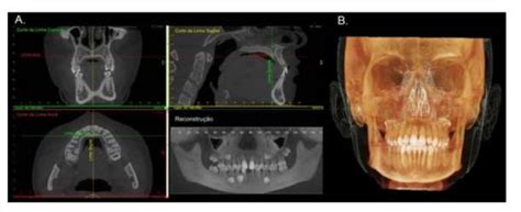 Tomografia Computadorizada Reformatações Multiplanares E Reconstrução Download Scientific