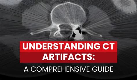 Understanding Ct Artifacts A Comprehensive Guide