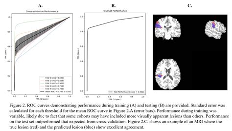 Towards A Multimodal Deep Learning Framework For Focal Cortical Dysplasia Detection And Delineation
