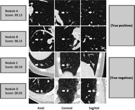 Evaluation Of A Novel Deep Learning Based Classifier For Perifissural