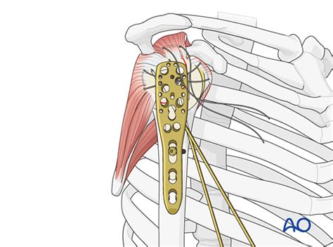 Orif Plate Fixation For Avulsion Of The Greater Tuberosity