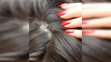 Best Foods To Eat To Reduce Dandruff Naturally