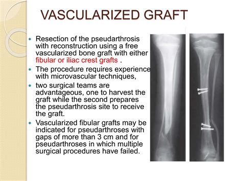 Pseudoarthrosis Of Tibia Pptx