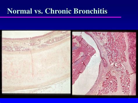 Ppt Pulmonary Pathology Powerpoint Presentation Free Download Id