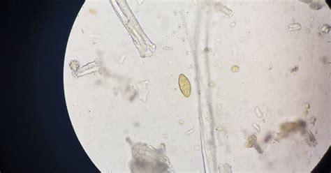 암 유발 장내기생충 감염 올해 소폭 늘어…하동·구례·안동 최고