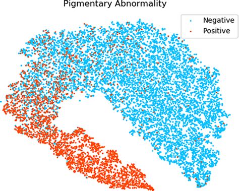 Automation Of Macular Degeneration Classification In Areds Opth Automation Of Macular Degeneration Classification In Areds Opth