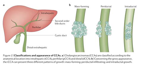 Intrahepatic Cholangiocarcinoma Surgical Art And Culture