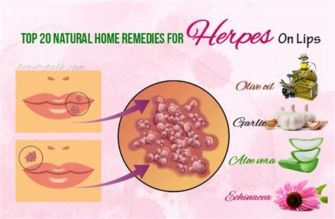 Best Treatment For Herpes On Face Jdkjs