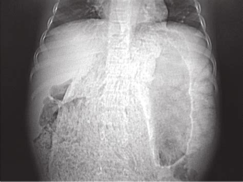 plain abdominal radiograph showing abdominal distension and grossly
