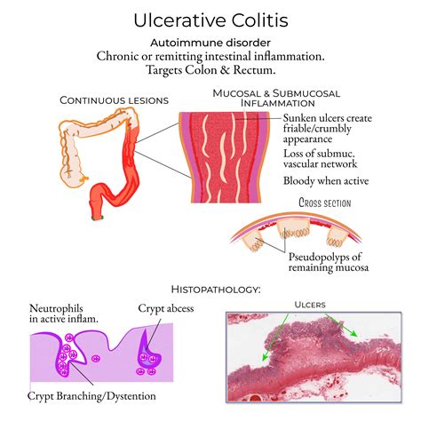 Clinical Pathology Glossary Ulcerative Colitis Ditki Medical