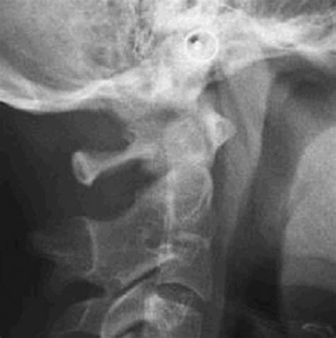 Cervical Spine C2 And C3