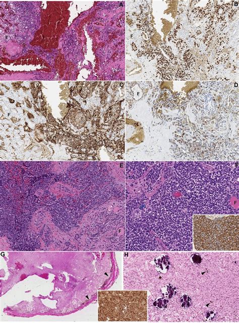 Primary Sarcoma Of The Thyroid Gland Ad An Epithelioid Angiosarcoma