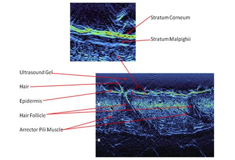 High Resolution Ultrasound Dermal Imaging For Assessing Skin Treatments