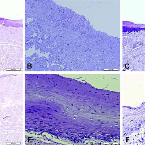 Placement Of The Acellular Dermal Matrix Adm Graft A The Download Scientific Diagram