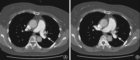 Asymptomatic Pulmonary Embolism Happened Within 12 H After Arthroscopic Download Scientific
