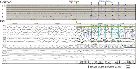Epileptiform Activity Can Precede Arousal And Rns System Stimulation Download Scientific