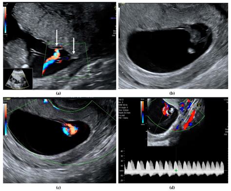 Early Ultrasound Identification Of Cord Entanglement In Monochorionic Monoamniotic Twin