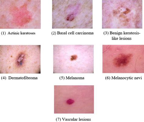 Skin Lesion Classification Of Dermoscopic Images Using Machine Learning