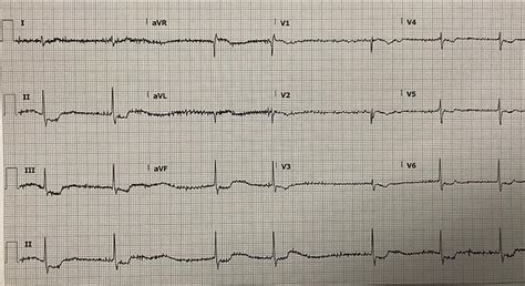 Ecg Challenge August 2018 Emra