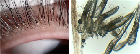 The Photothermal Effect Of Intense Pulsed Light And Lipiflow In Eyelid