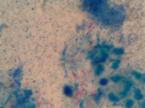 Tb Classification Classification Dataset By Sg