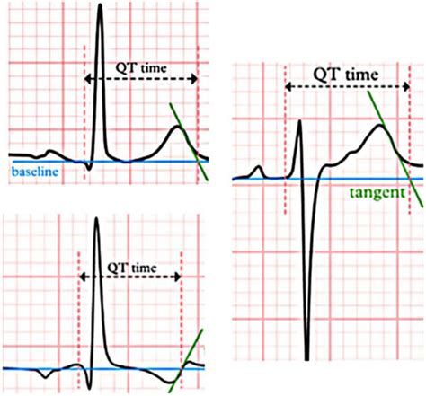 Qt Measuring Interval Cardiac Sciences Manitoba