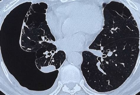 Computed Tomography Of The Thorax Showing Right Sided Loculated Download Scientific Diagram