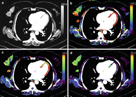 Perfusion Ct Principles Technical Aspects And Applications In Oncology Radiology Key