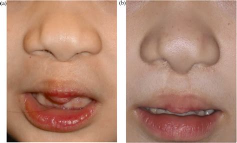 Two Staged Tubercle Plasty Using A Banked Prolabial Vermilion Island