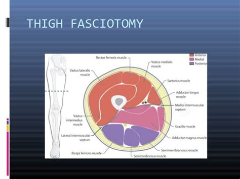 Fasciotomy