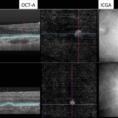 Nonexudative Neovascularization Visualized With Oct A But Only Download Scientific Diagram
