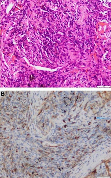 A Lung Biopsy Showed Nodular And Storiform Fibrosis And Hyperplasia Download Scientific