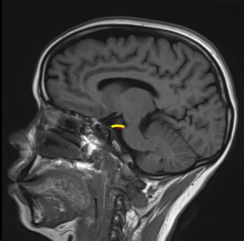 Trigeminal Nerve Mri Sagittal