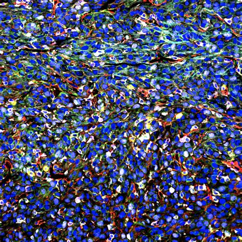kurt doyen on linkedin spatial architecture of tumor and immune cells