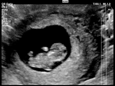 20 Weeks Pregnant Ultrasound Abnormalities