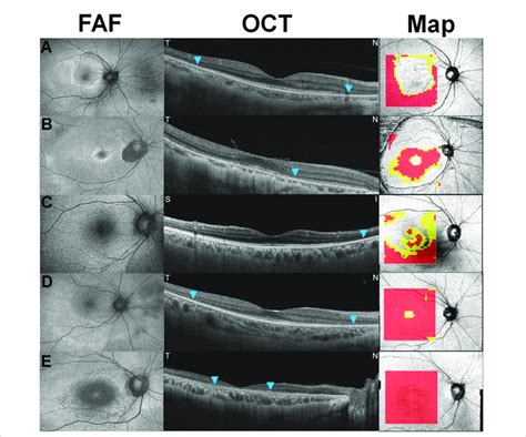 Five Recognizable Patterns A Pericentral Ring A Parafoveal Ring