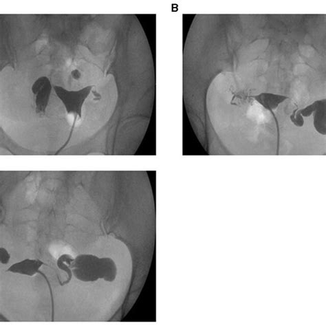 Diagnosis Of Fallopian Tube Patency Or Occlusion By Download