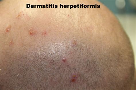 Dermatitis Herpetiformis Causes Symptoms Diagnosis And Treatment