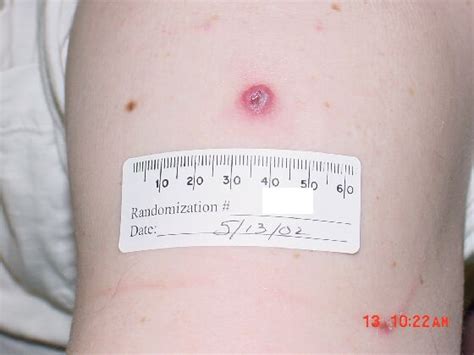 Comparison Of Reactions For First Time Vaccinees And Revaccinees